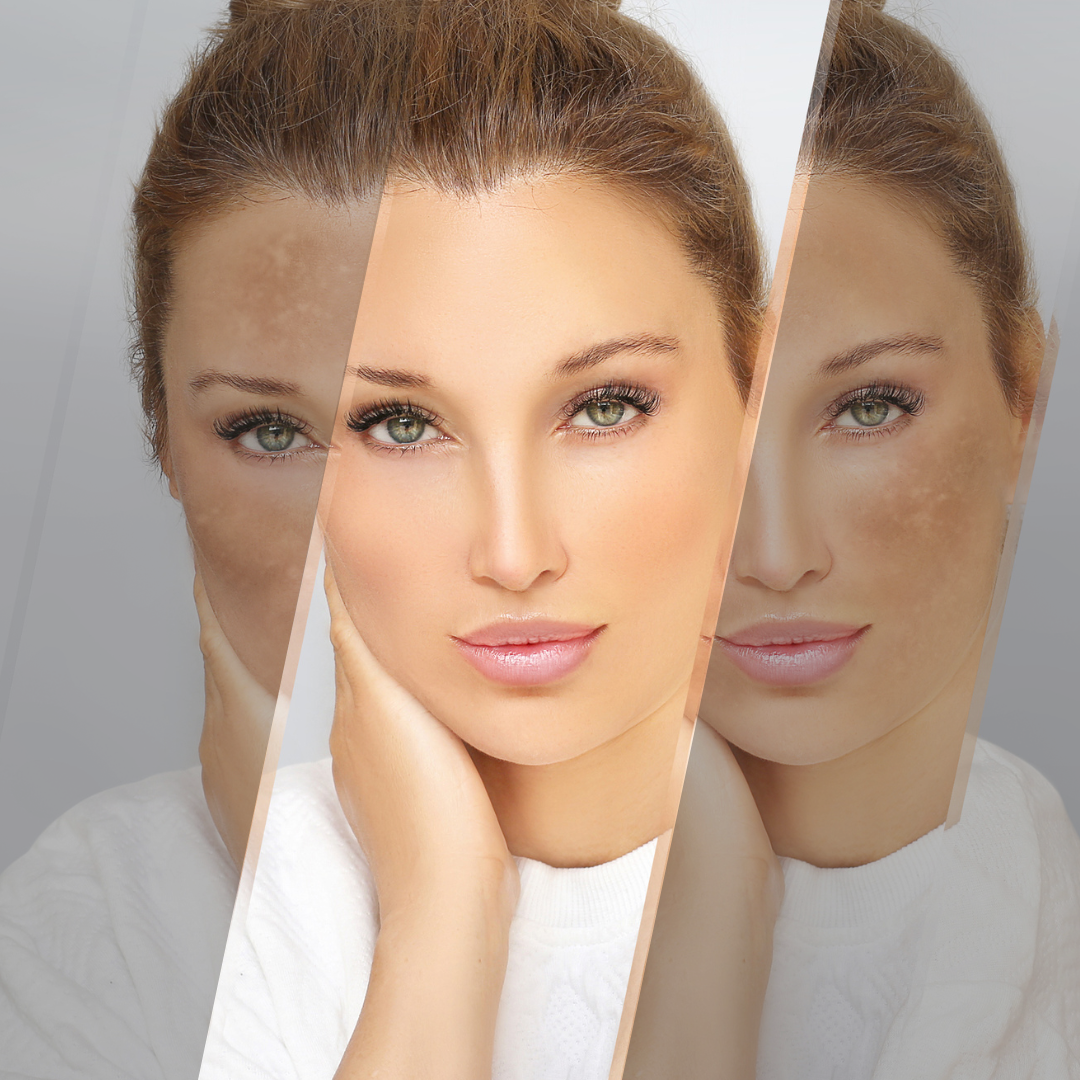 Melasma Hyperpigmentation Treatment in Hawaii | Skin Kahala